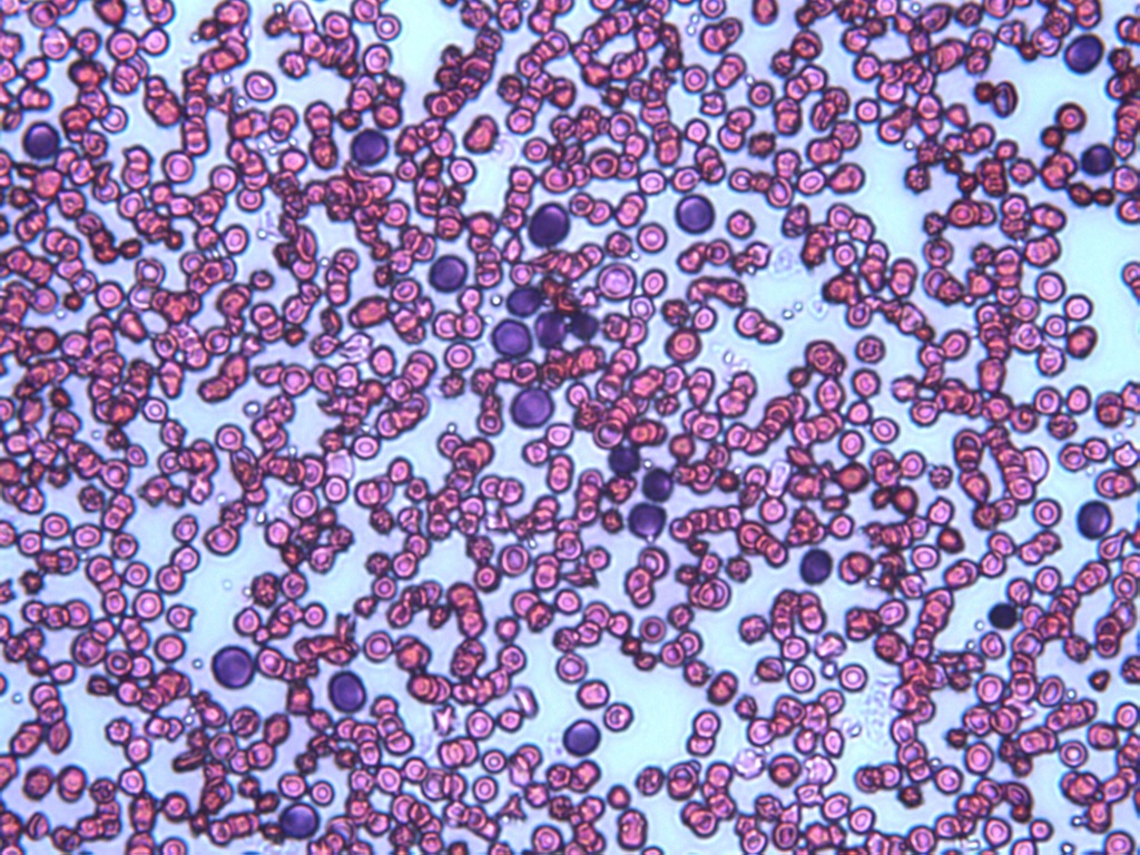 Neue Rolle des Tumorsuppressors STAT3β bei Leukämie entdeckt ...